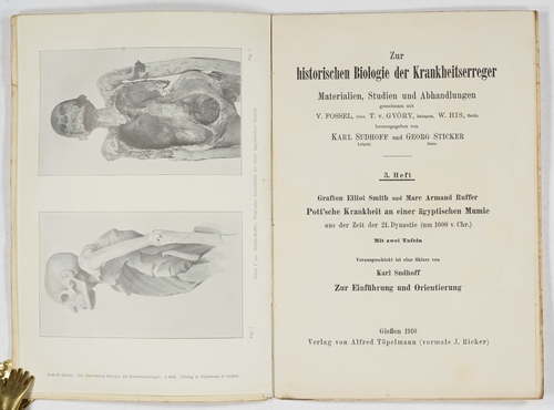 Pott'sche Krankheit an einer ägyptischen Mumie aus der Zeit der 21 ...