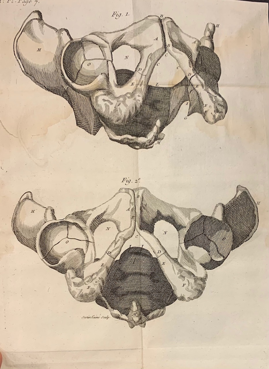 Parallele des Différentes Manieres de Tirer la Pierre Hors de La Vessie ...
