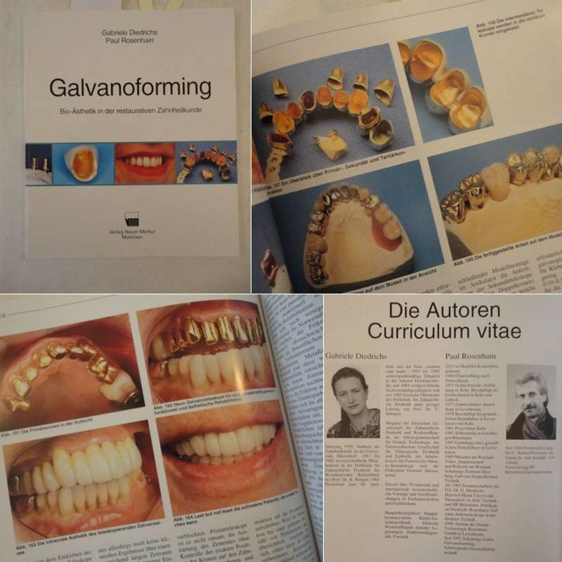 Galvanoforming. Bio-Ästhetik in der restaurativen Zahnheilkunde * mit ...