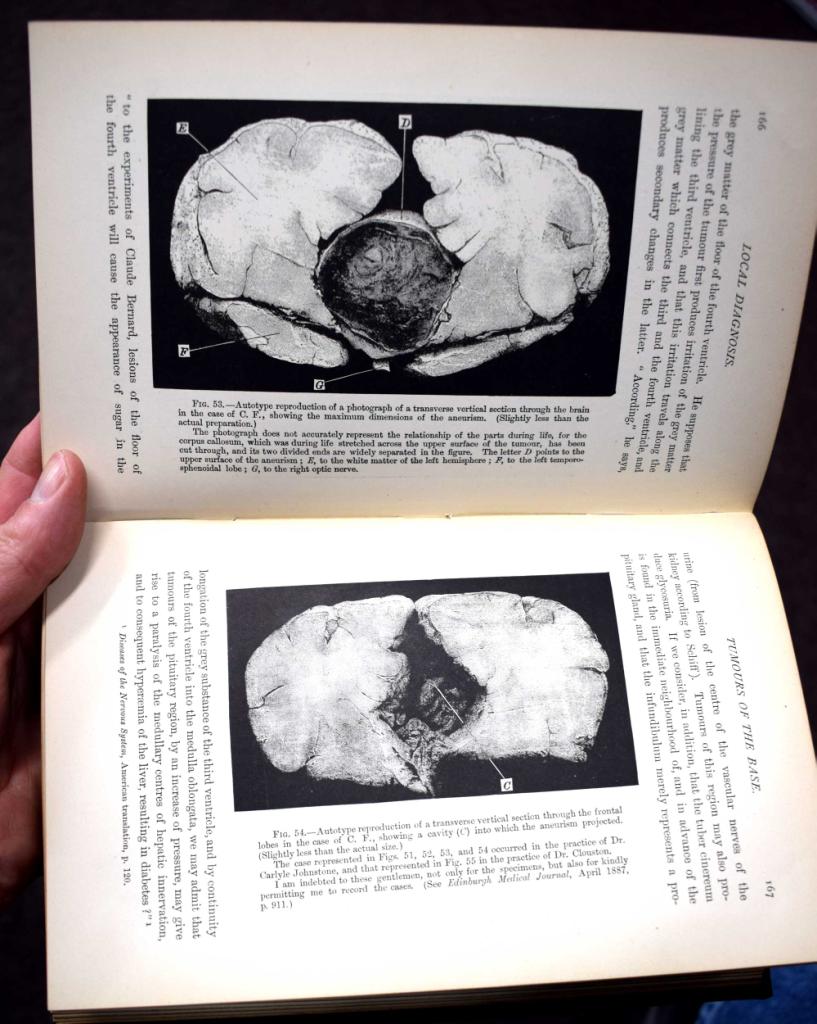 Intracranial Tumours by Bramwell, Byron: Good Green hardback cloth ...