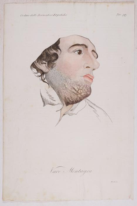 Clinica - 4/30 : Quarto Ordine delle Dermatosi erpetiche, Tav.30: Varo ...