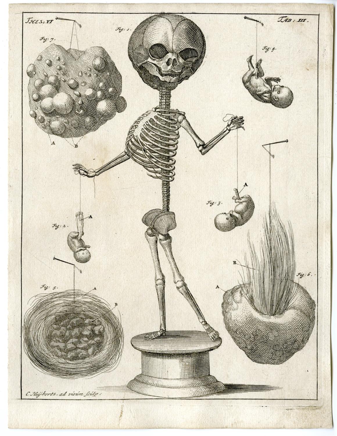 Antique Print-ANATOMY-HUMAN SKELETON-EMBRYO-TUMOR-TAB III-HUIJBERTS ...