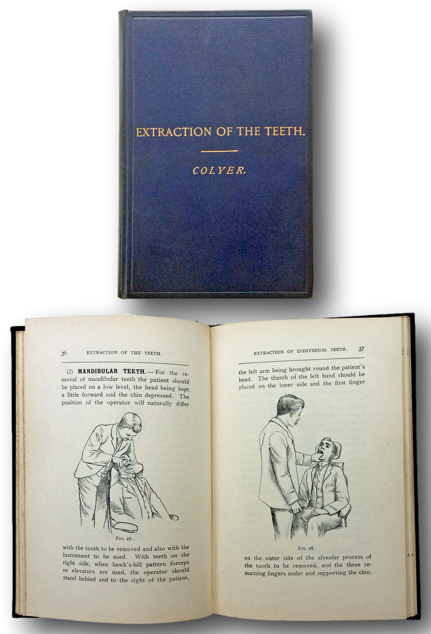 EXTRACTION OF THE TEETH. by COLYER, J F.[ Sir James Frank Colyer KBE ...