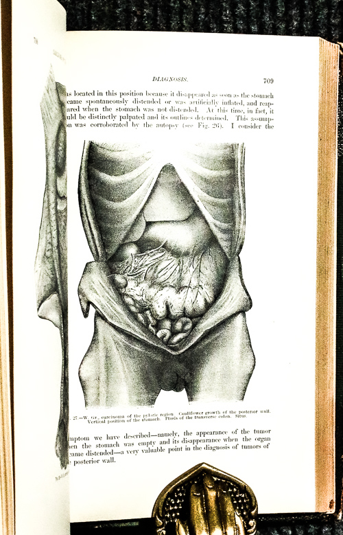 Nothnagels Practice: Diseases Of The Stomach Authorized Translaton From ...