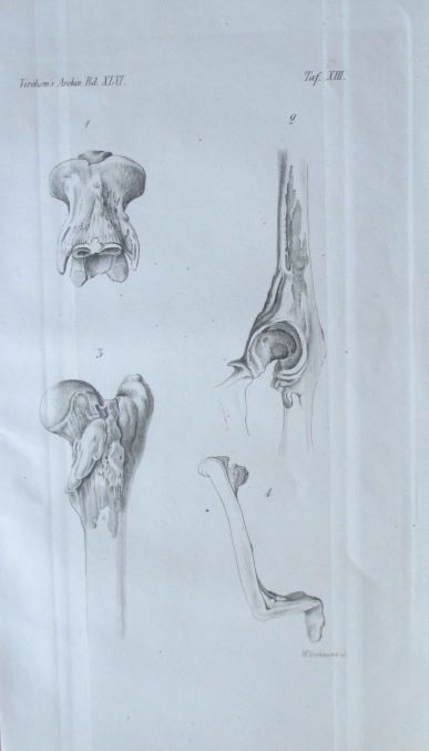 Osteomalacie/Knochenerweichung. Lithographie von W. Grohmann, 21,5 x 13 ...