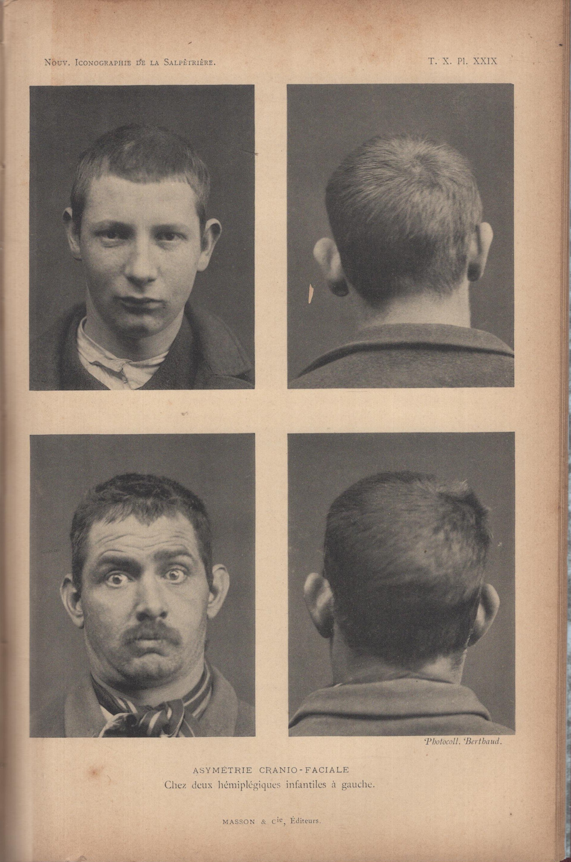 Nouvelle Iconographie De La Salpêtrière Tome X n° 4 juillet-août 1897 ...