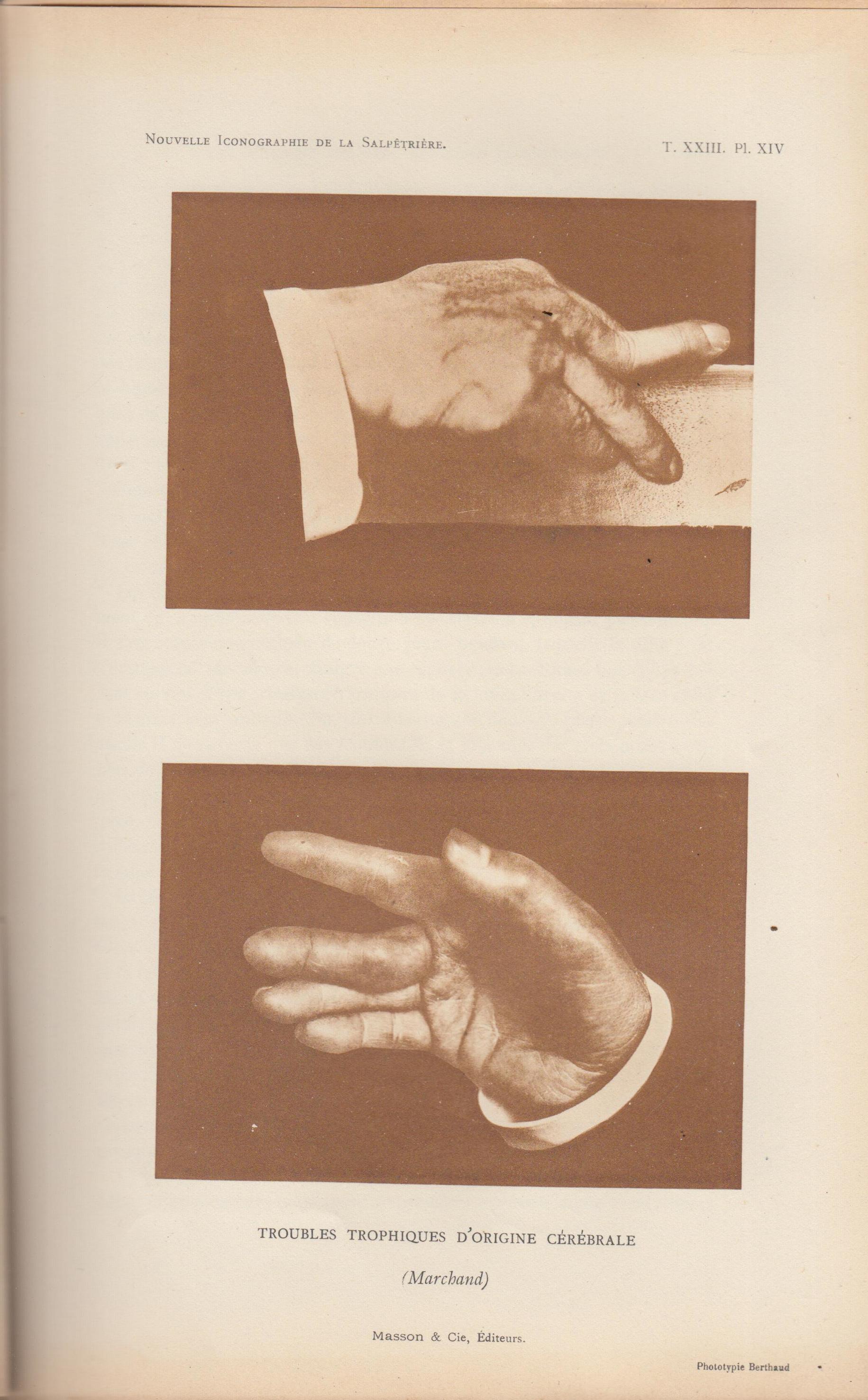 Nouvelle Iconographie De La Salpêtrière N° 2 Mars-Avril 1910 by Mario ...