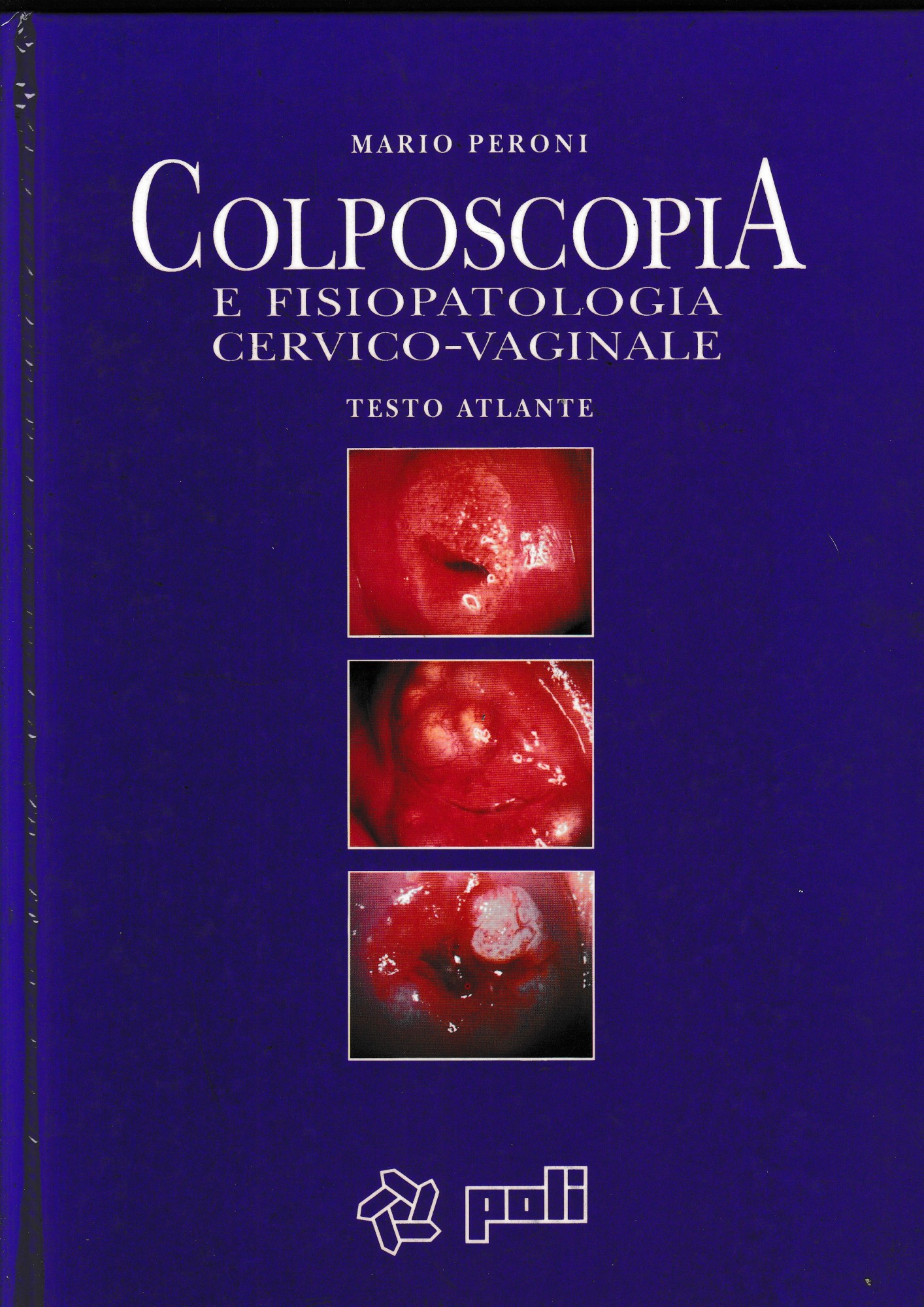 Colposcopia e fisiopatologia cervico-vaginale. Testo atlante da Mario ...