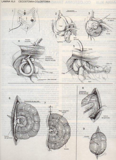 LAMINA V20103: Cecostomia-colostomia de Dr. Robert M. Zollinger: (1979 ...