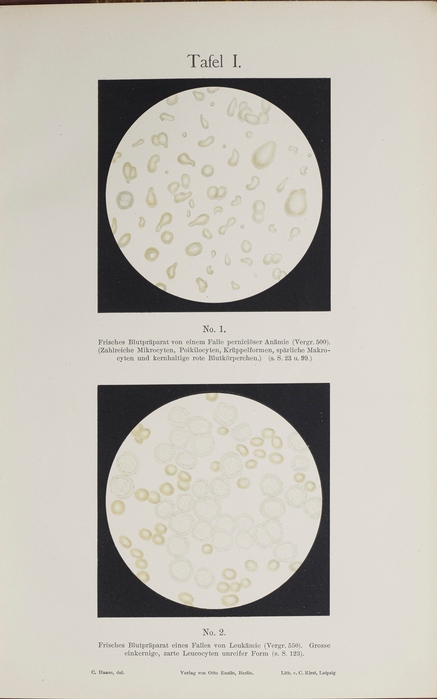Klinische Pathologie des Blutes. by Grawitz, Ernst: (1896) | Antiq. F ...