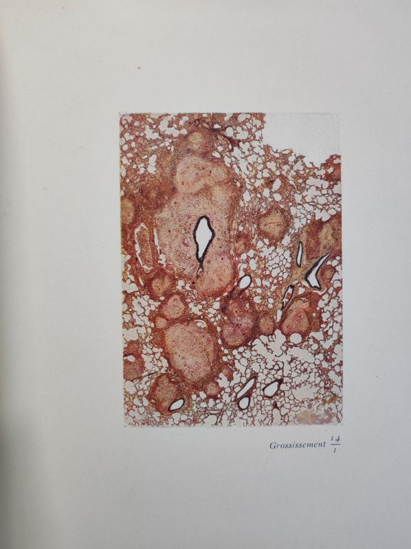 La Tuberculose Pleuro-Pulmonaire. Cent sept planches autochromes. by ...