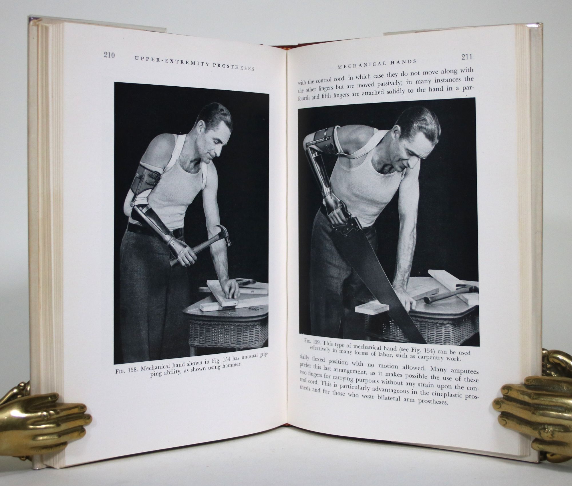 Amputation Prosthesis: Anatomic and Physiologic Considerations with ...