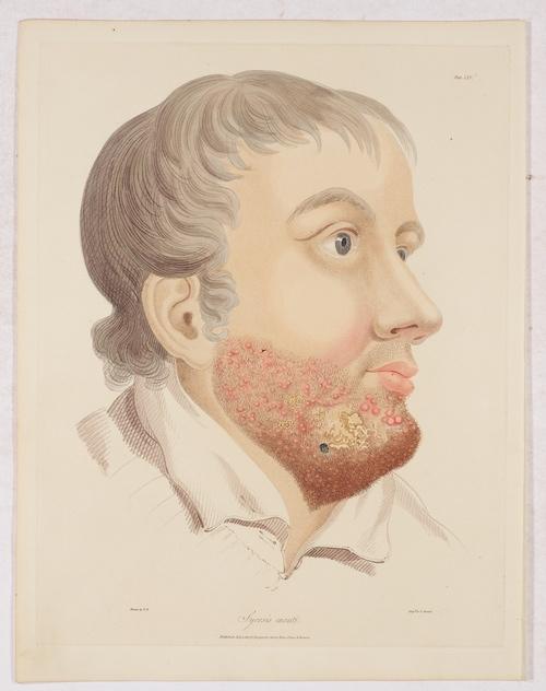 Sycosis menti. by Bateman, Thomas =: (1817) Art / Print / Poster ...