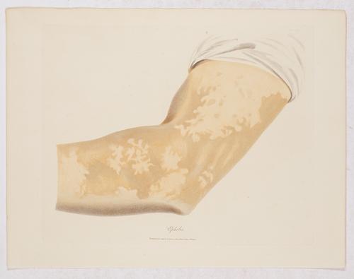 Ephelis. von Bateman, Thomas =: (1817) Kunst / Grafik / Poster | Antiq ...