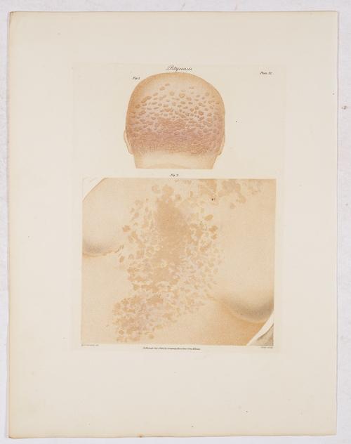 Pityriasis capitis; Pityriasis versicolor. de Bateman, Thomas =: (1815 ...