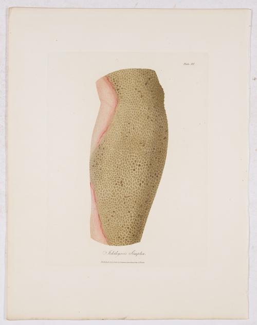 Ichthyosis simplex. by Bateman, Thomas =: (1815) Art / Print / Poster ...