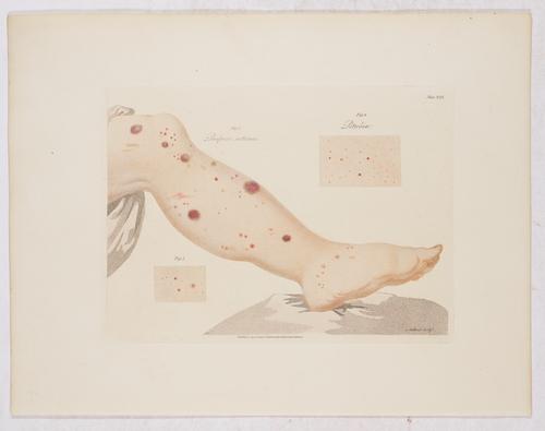 Purpura simplex; Purpura haemorrhagica. von Bateman, Thomas =: (1816 ...