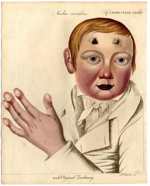 Morbus coeruleus. Zur Erläuterung der blauen Krankheit. von Peters ...