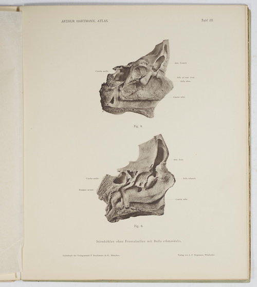 Atlas der Anatomie der Stirnhöhle, der vorderen Siebenzellen und des ...