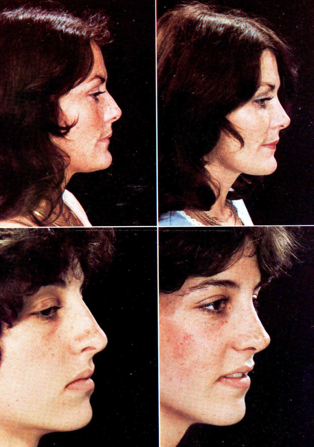 Aesthetic rhinoplasty. [Applied anatomy and physiology -- Aesthetics ...