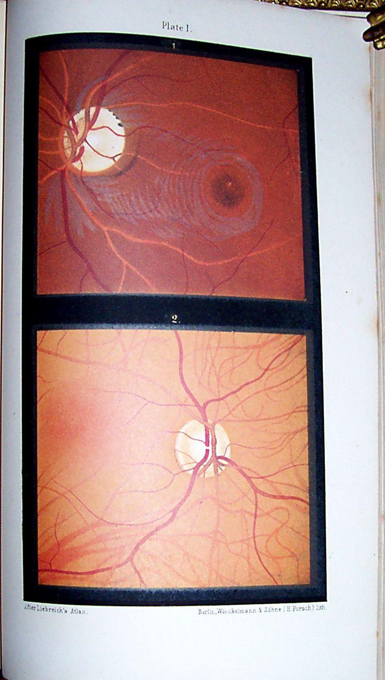 A Treatise on the Diseases of the Eye. Full Leather Binding. by WELLS ...