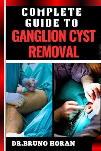Complete Guide To Ganglion Cyst Removal Comprehensive Handbook To Expert Techniques Home